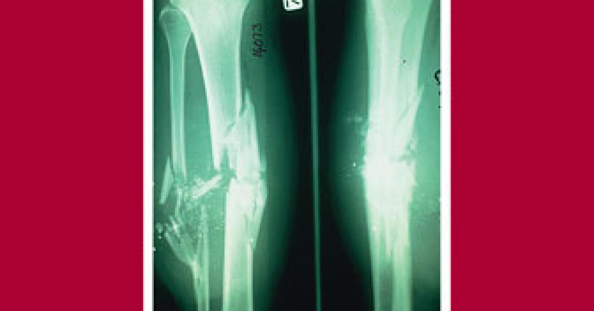 War Wounds with Fractures: A Guide to Surgical Management ...